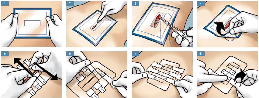 OptiClose - bezstehový uzávěr operační rány při zavádění intravenózních ...