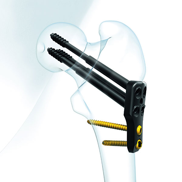 Ani nevnímám, že mám v těle šroub | Braunoviny