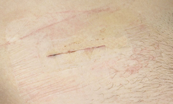 OptiClose prináša uzatváranie rán bez stehov - prvé skúsenosti z ...