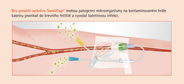 Proplachovací stříkačka Omniflush® s uzávěrem SwabCap® účinně chrání ...